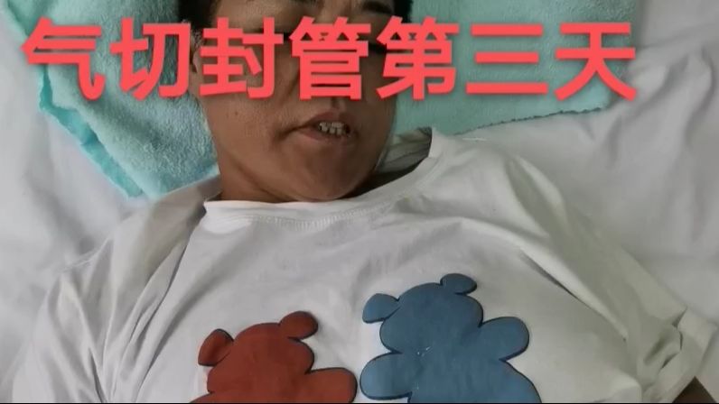 脑炎,气切封管第三天。