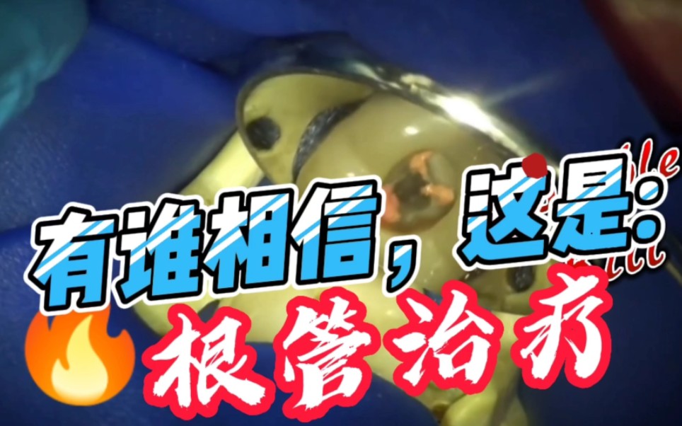 根管治疗是这样做的!你敢相信吗?