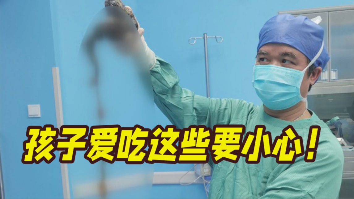 家长注意!9岁女孩突发腹痛 胃里竟取出了一个头发团.