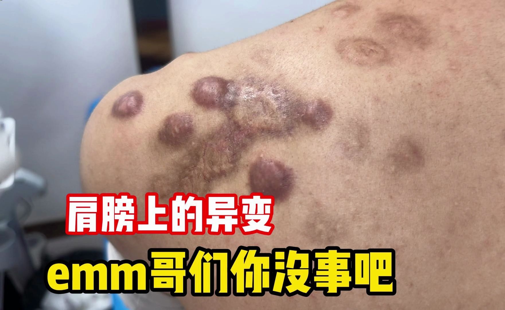 胳膊上有异变,4分钟超长,视频解说,疤痕疙瘩怎么治才能不复发。进来...