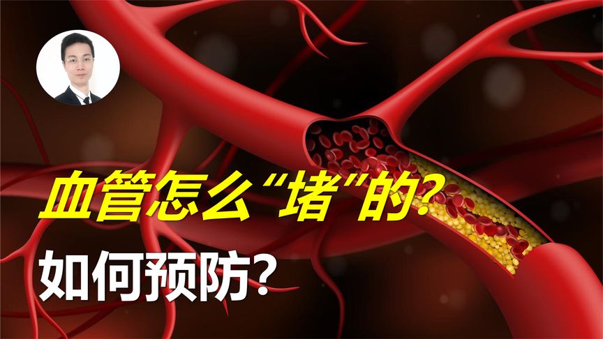 动脉血管究竟是如何“堵塞”的?预防堵塞,最佳策略是哪三点?