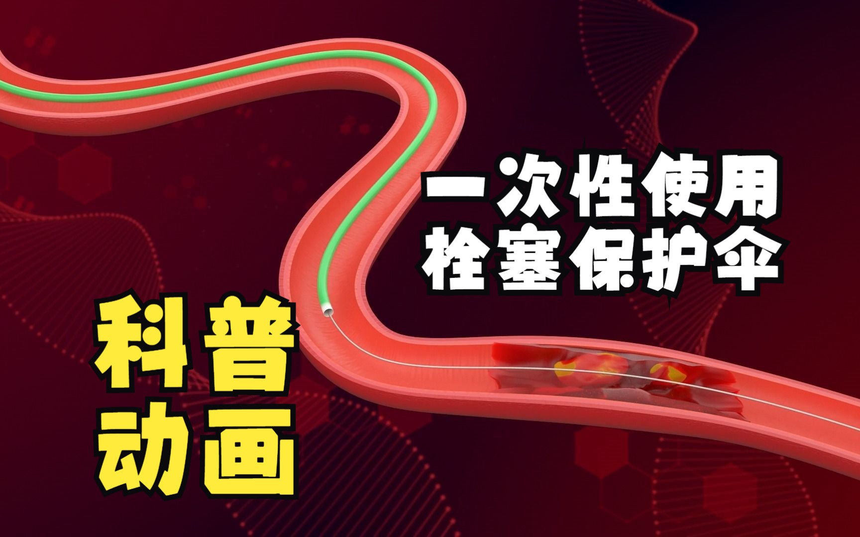 【医疗科普动画】-为患者提供血管远端栓塞保护的一次性使用栓塞...