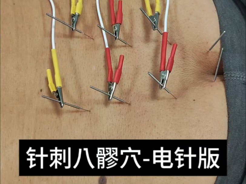 精准针刺八髎穴-电针版