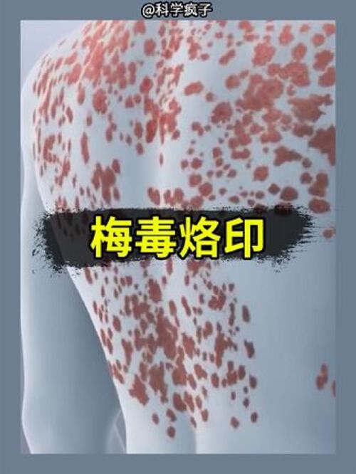一经感染,终生标记,梅毒到底有多可怕?