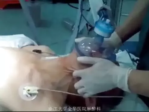 swf-经鼻盲探气管内插管--牙齿松动