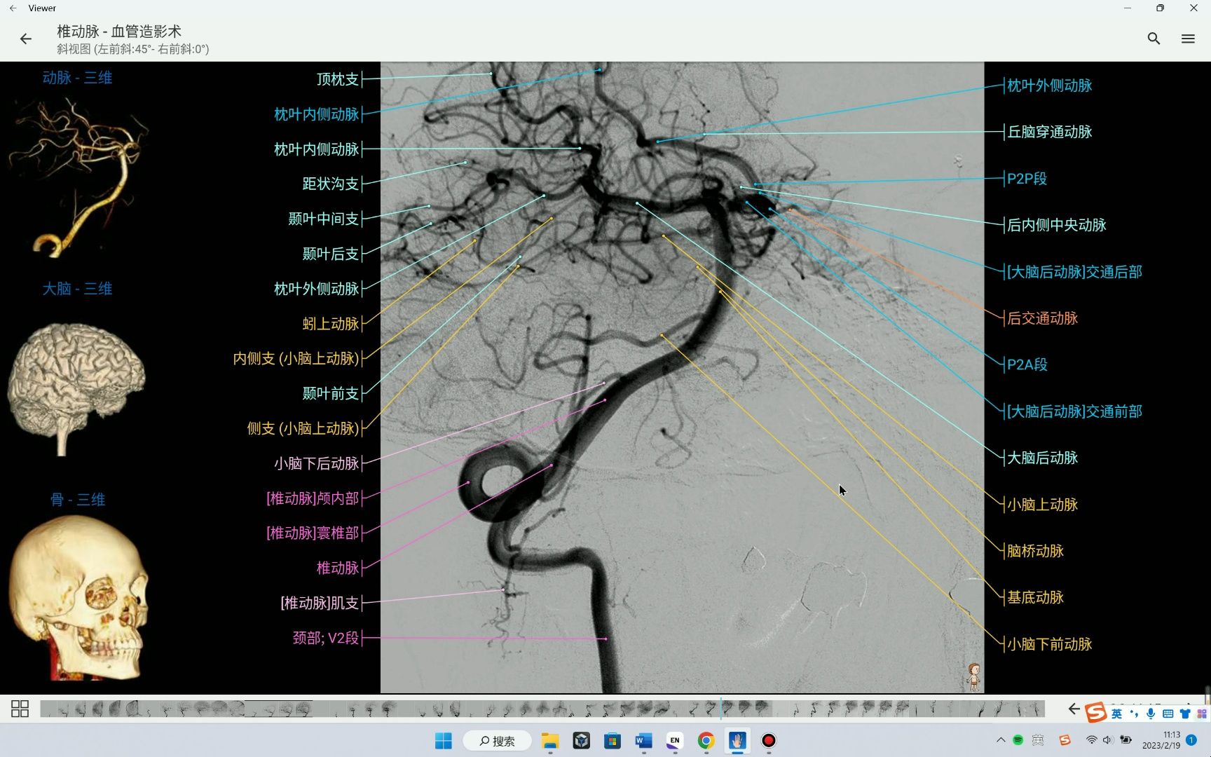医学影像学,脑血管造影