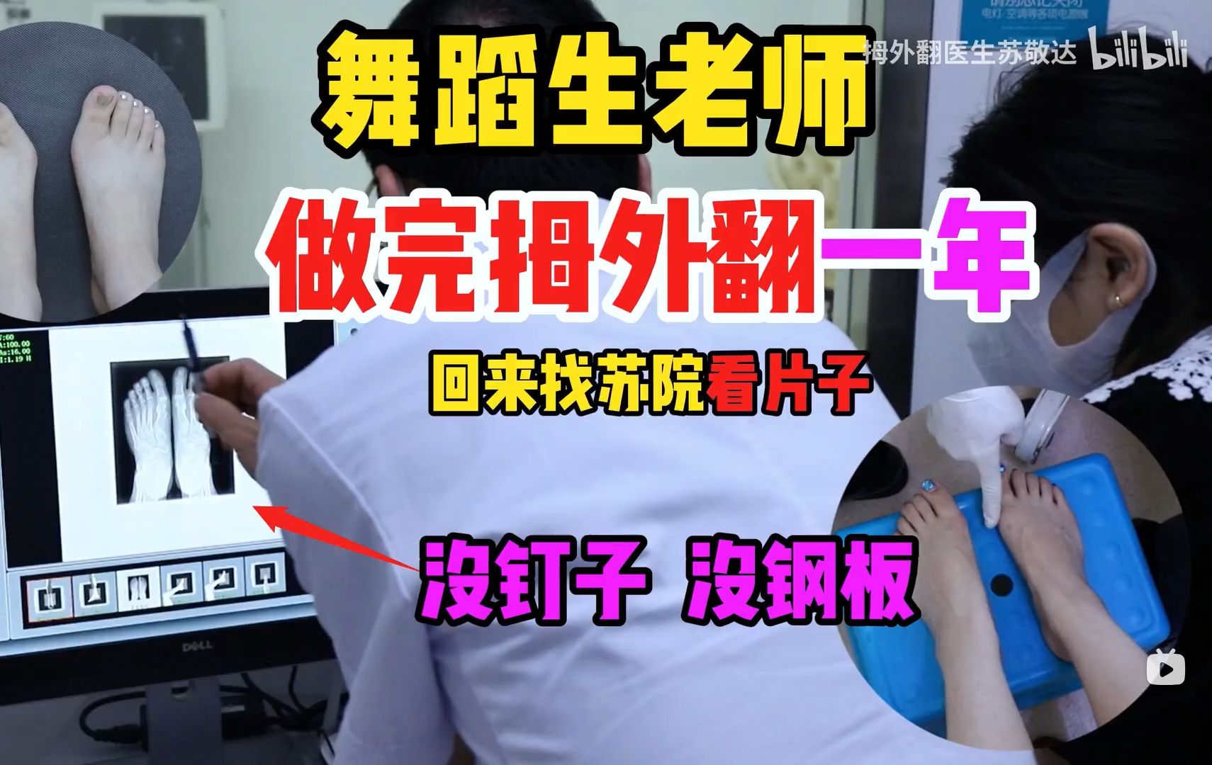 【苏敬达】23岁北京姑娘做拇外翻微孔手术1年后回院复查,恢复得很好。