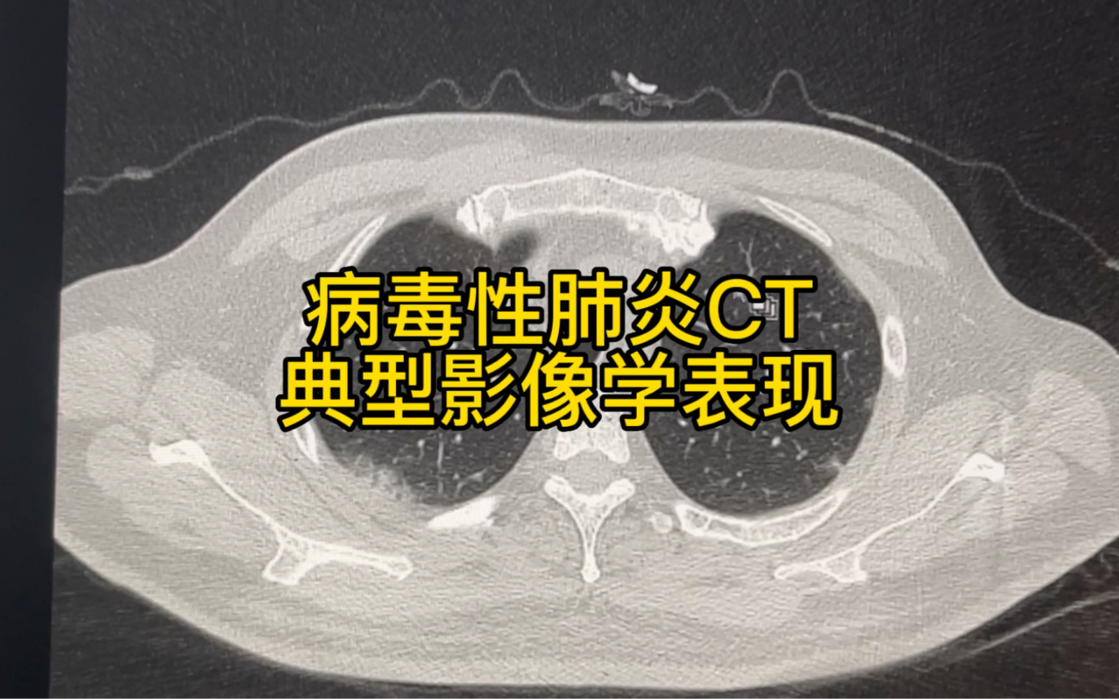 4天时间病毒性肺炎影像学有所吸收,看看典型病毒性肺炎CT上有哪些...
