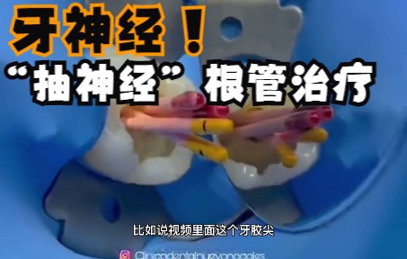 中国牙骑士科普“抽神经”根管治疗详细步骤,让你牙齿不再疼痛