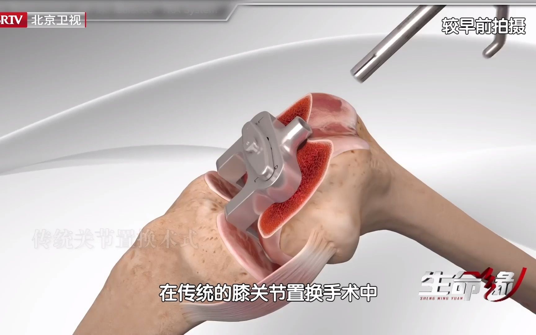 1分钟不到重建下肢骨骼?3D影像重建和3D打印技术应用在医学领域有...