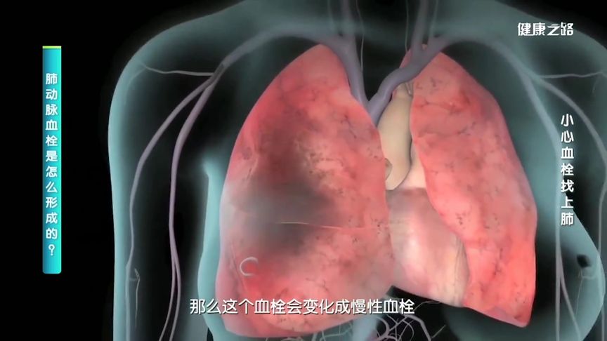 肺动脉血栓是怎么形成的