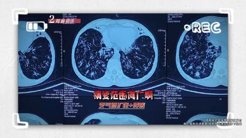 支气管扩张合并哮喘,用药14天,一身轻松!