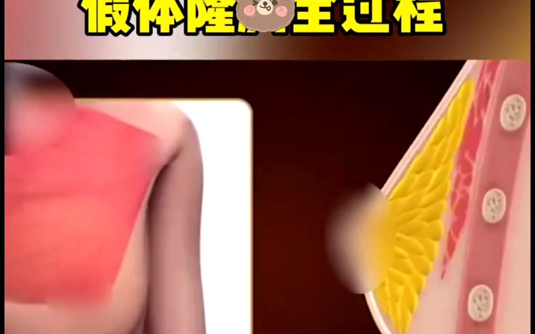 假体丰胸全过程,动画演示!