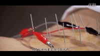 电针治疗腰椎间盘突出
