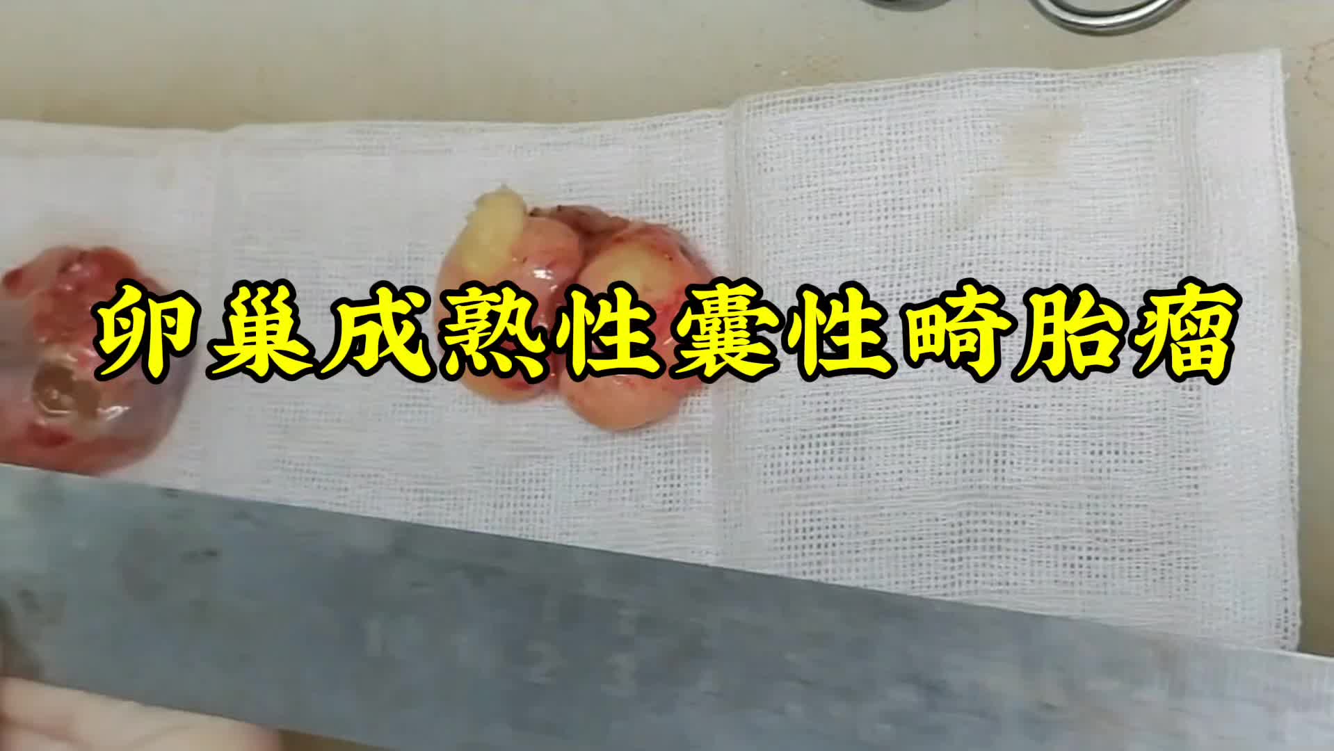 ...占卵巢肿瘤约20%。发病年龄:育龄期女性。临床表现:腹痛或腹部肿块...