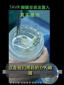 《TAVR瓣膜安装及介入》 真实记录瓣膜的结构及置入过程 #抖出健康...