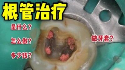 【某医】让人牙疼腿软的根管治疗到底是什么?要不要做?怎么做?