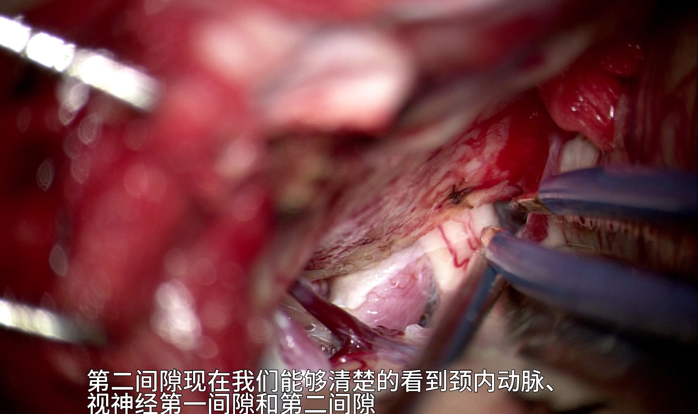2前颅底脑膜瘤-额外侧入路-暴露视神经和颈内动脉