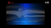 一次性骨牵引器操作视频_标清