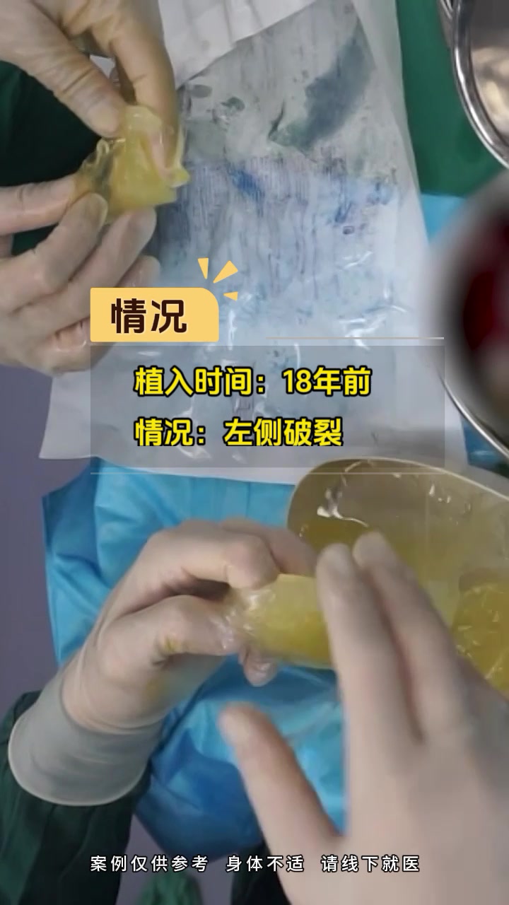 18年的#假体丰胸 取出后,为何左侧破裂?#女性健康 #案例分享 #变美