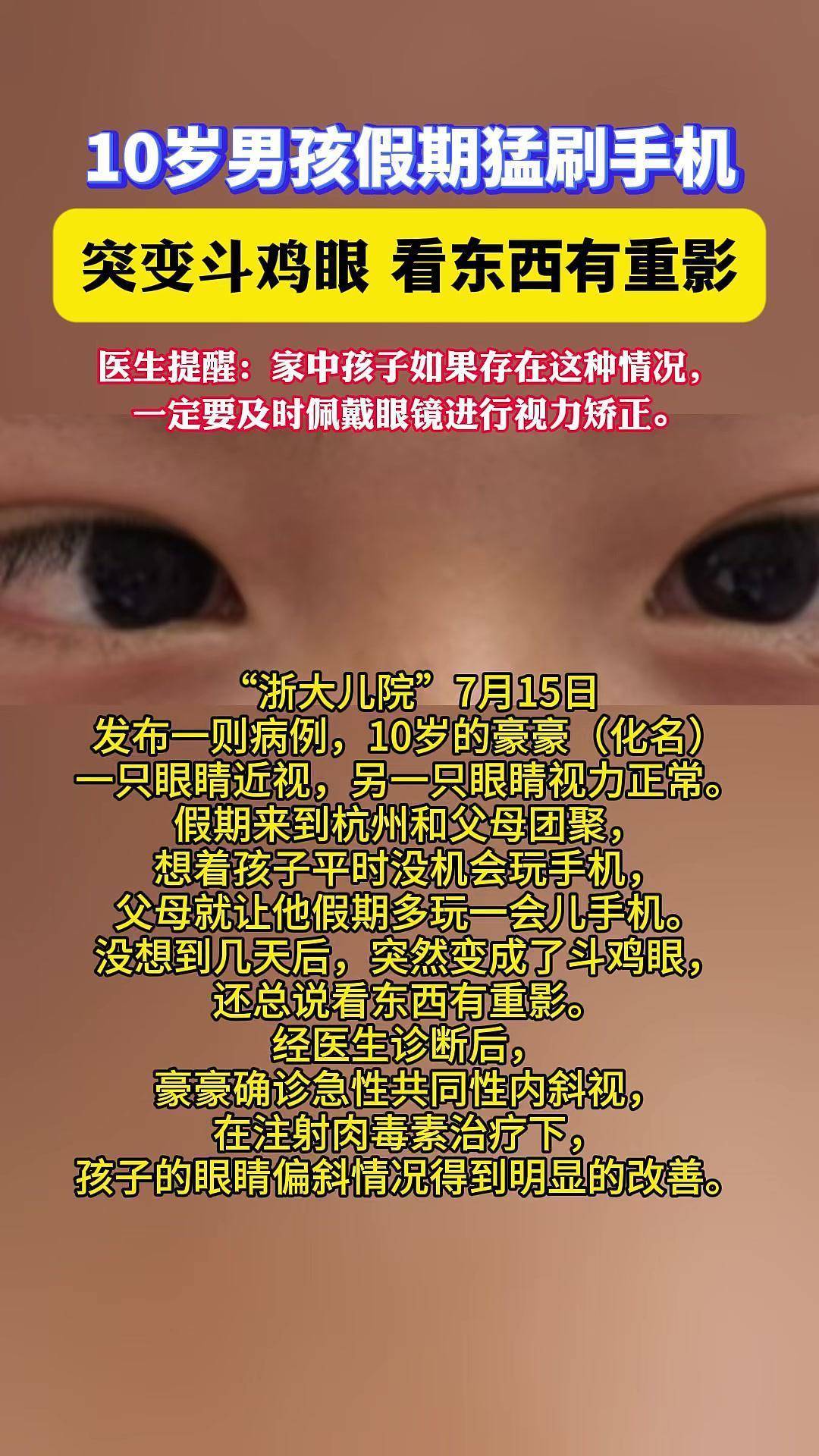 #10岁男孩假期猛刷手机突变斗鸡眼,看东西有重影
