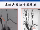 脑血管解剖与造影技术