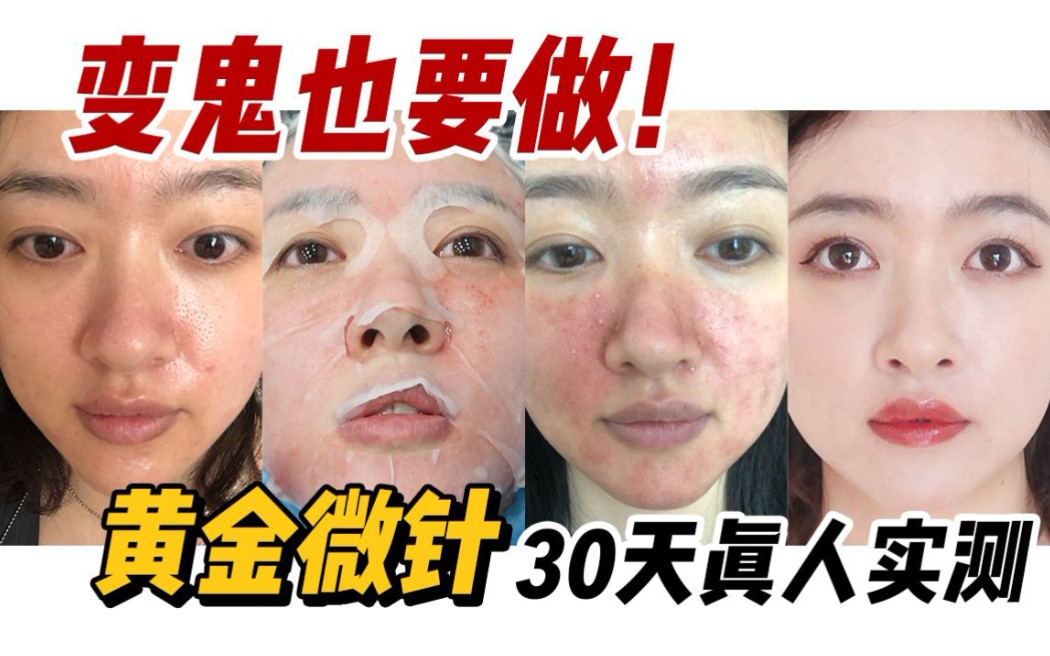 1次磨平毛孔痘坑?捧上天的黄金微针33天实录!是好是坏!看视频吧!