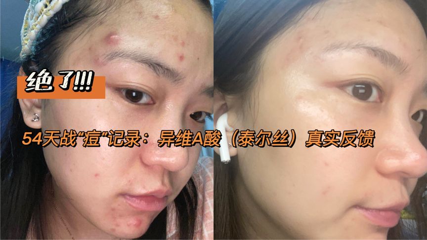 异维A酸(泰尔丝)——爆痘?烂脸?抑郁?变黑?还是痘肌的福音?