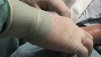 Arterial Puncture for Blood Gas Analysis-血气分析中动脉穿刺