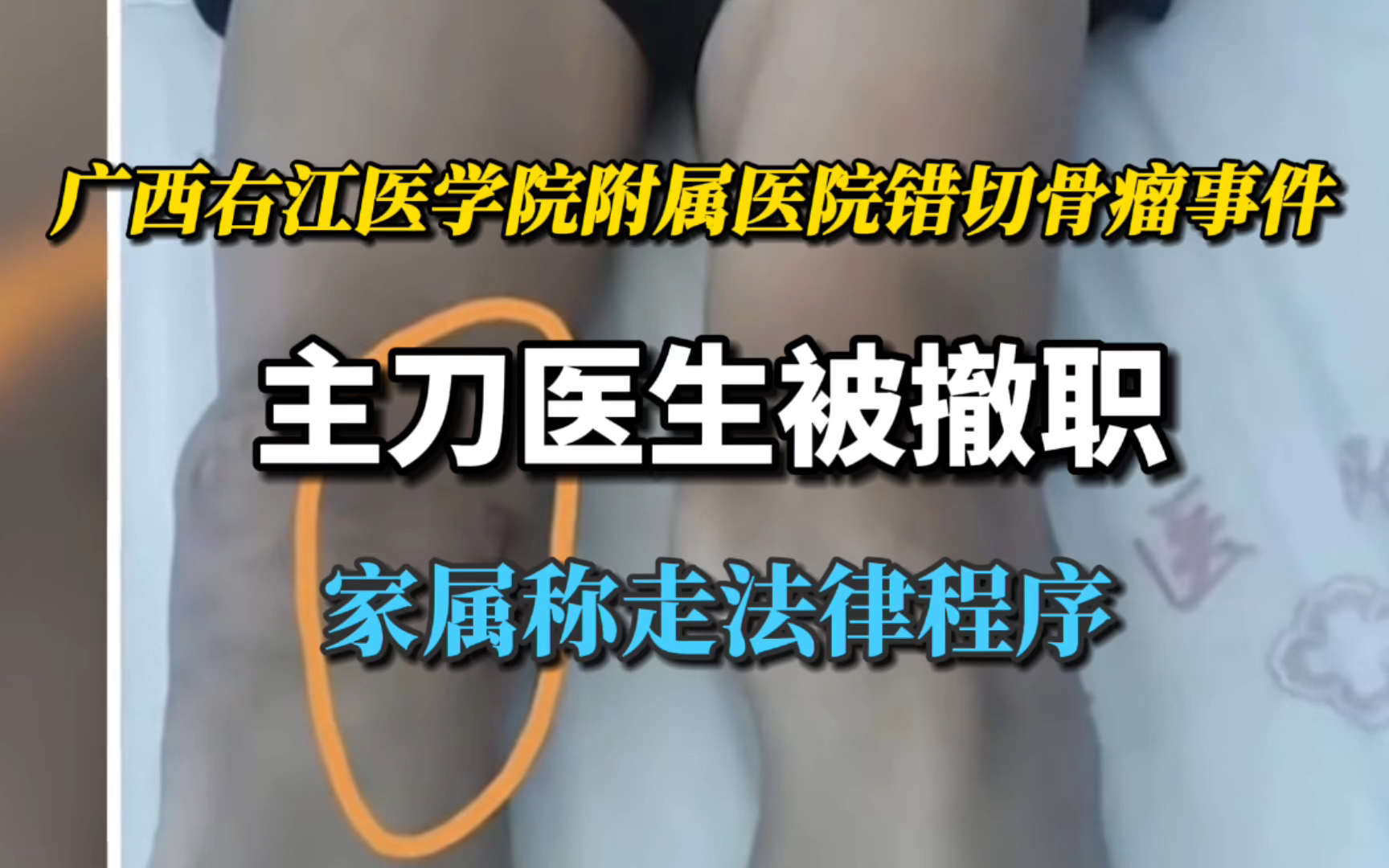 广西右江大三甲医院“错切骨瘤事件”主刀医生“科主任”被撤职 ...