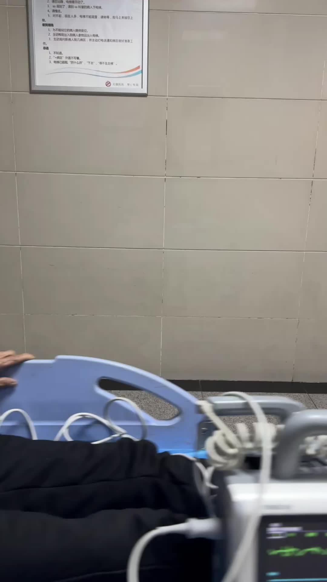 游离血栓堵塞冠状动脉致急性心梗一例: 患者,女,88岁,心房颤动病史...