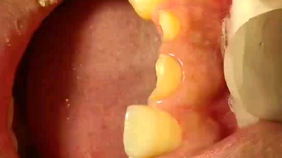 桩冠修复之插入纤维桩(张日贵牙医)