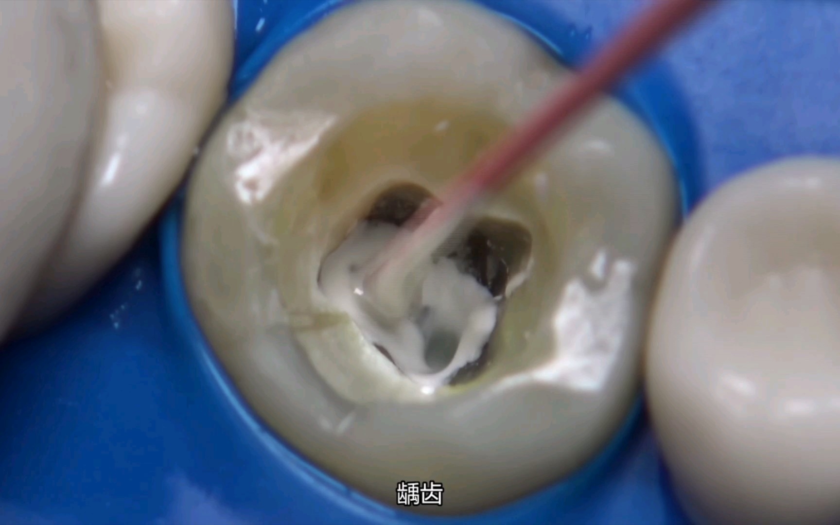 根管治疗戴牙冠全过程