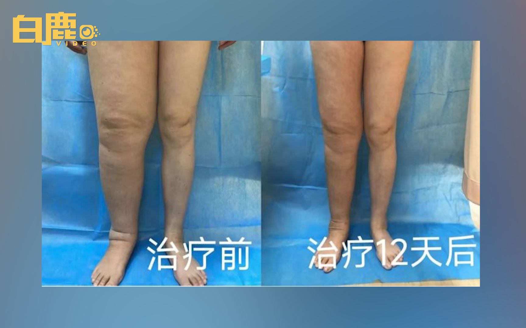 女子宫颈癌术后5年两腿粗细差16公分