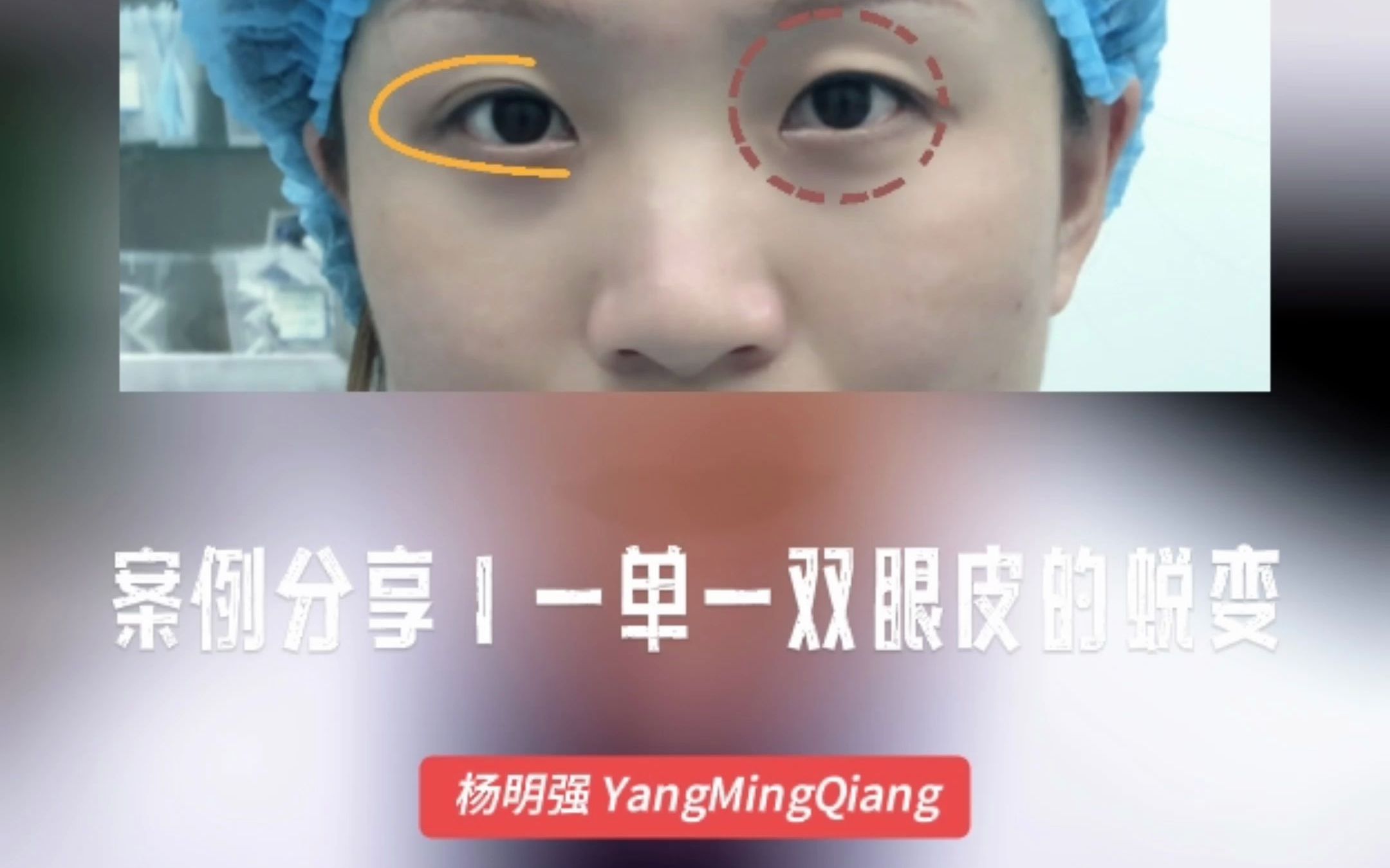 眼睛一单一双怎么办?如何改善呢?