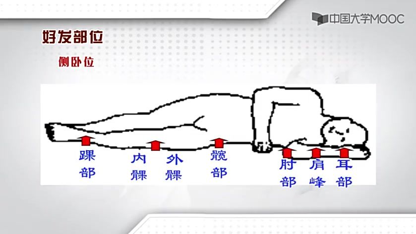 第四周 清洁卫生护理、休息与活动:患者压疮发生原因与风险评估2