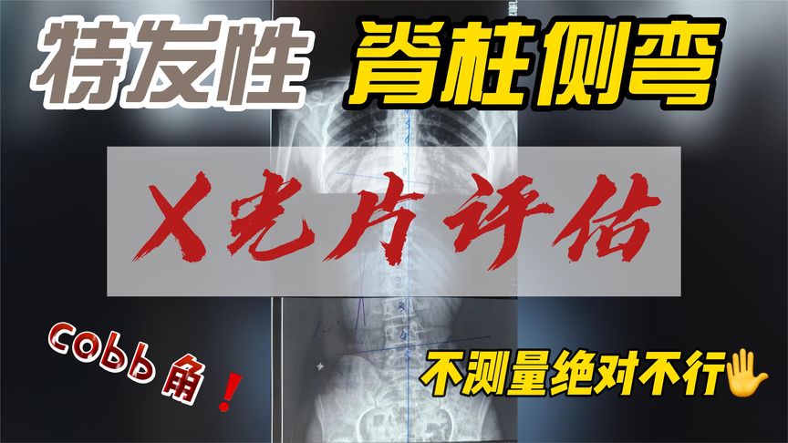 脊柱侧弯的严重程度通过Cobb角度测量方法对侧弯角度进行评估