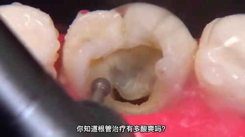 你知道根管治疗有多酸爽吗?