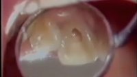 001根管治疗经典教程