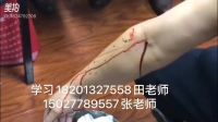 曲泽放血治疗心肺疾病