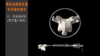 威曼U型钉手术操作动画演示
