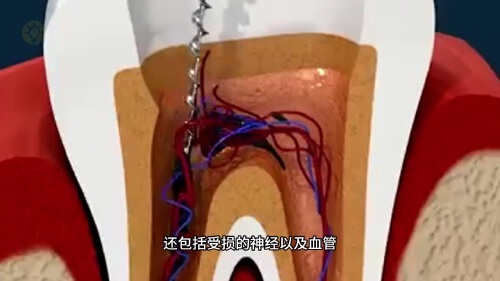 牙齿根管治疗究竟是怎样操作的?