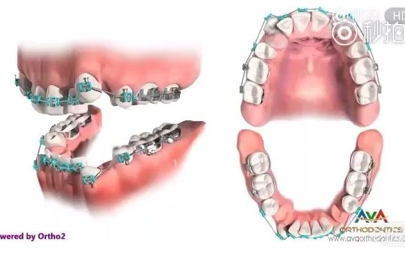 拔牙矫正的效果视频,不同牙齿问题,拔除不同牙齿的正畸治疗!