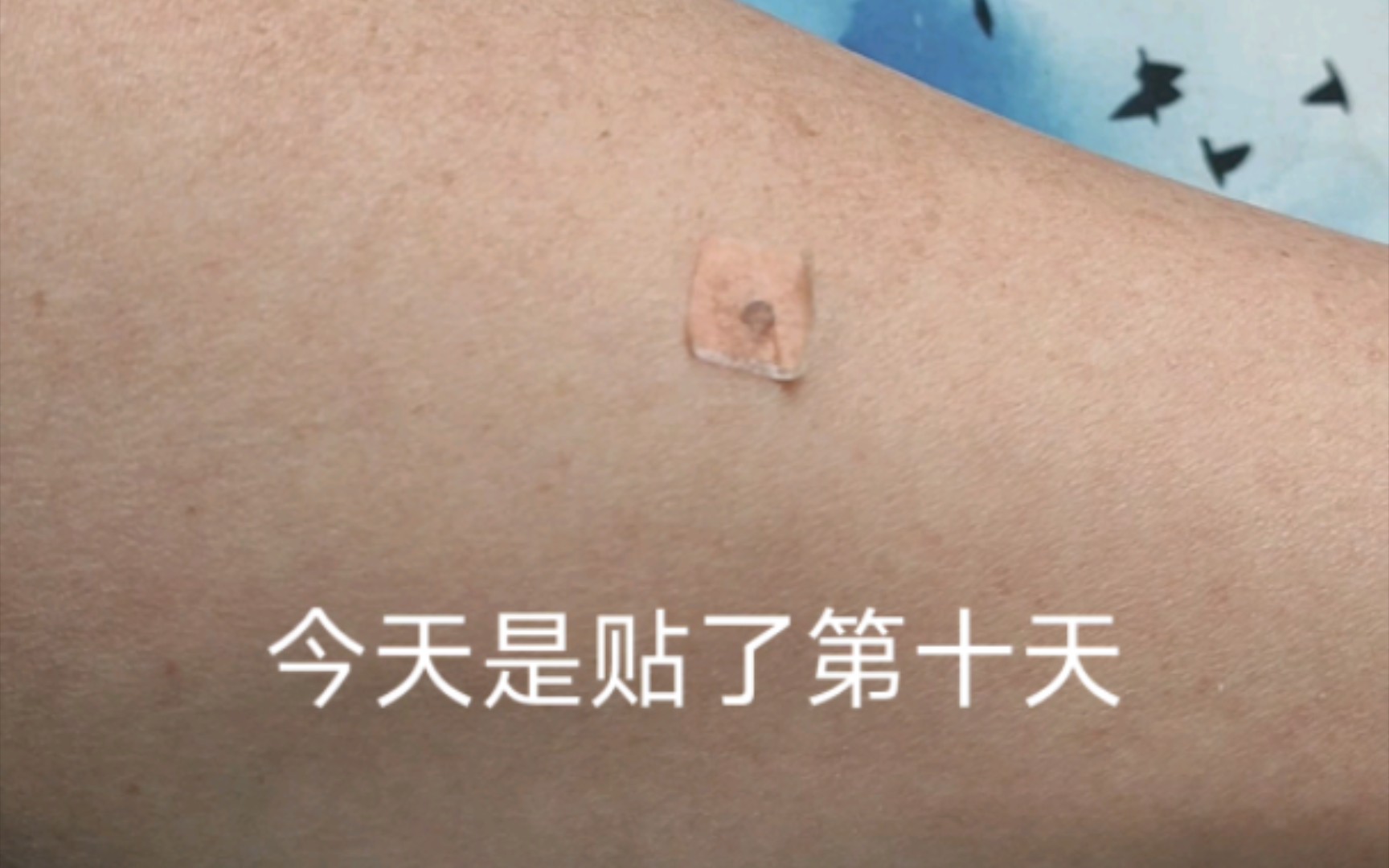 连续贴揿针第十天,揭开揿针后观察皮肤变化