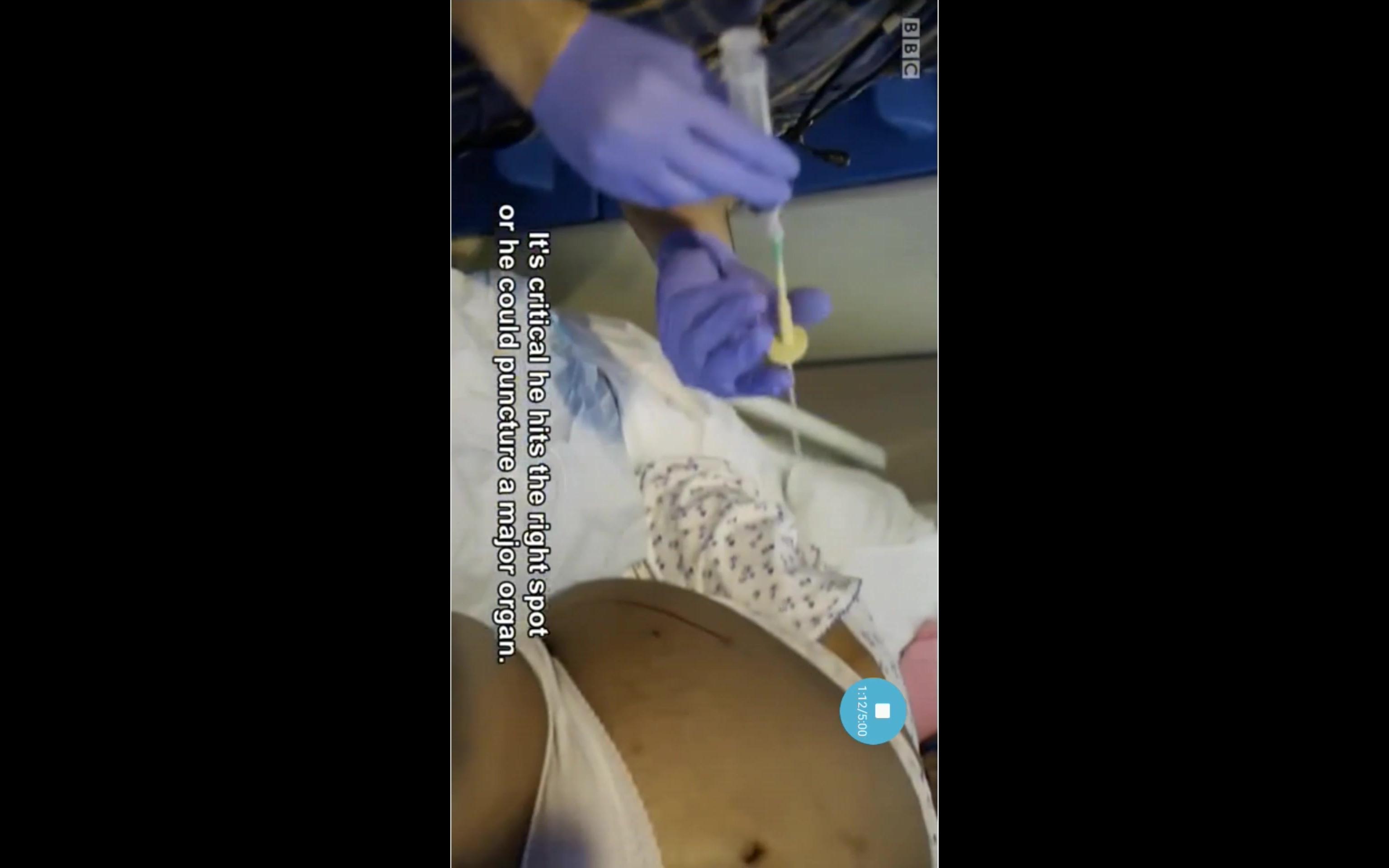 看剧学英语|跟着添翼国际护士培训学校老师了解Paracentesis (腹部...