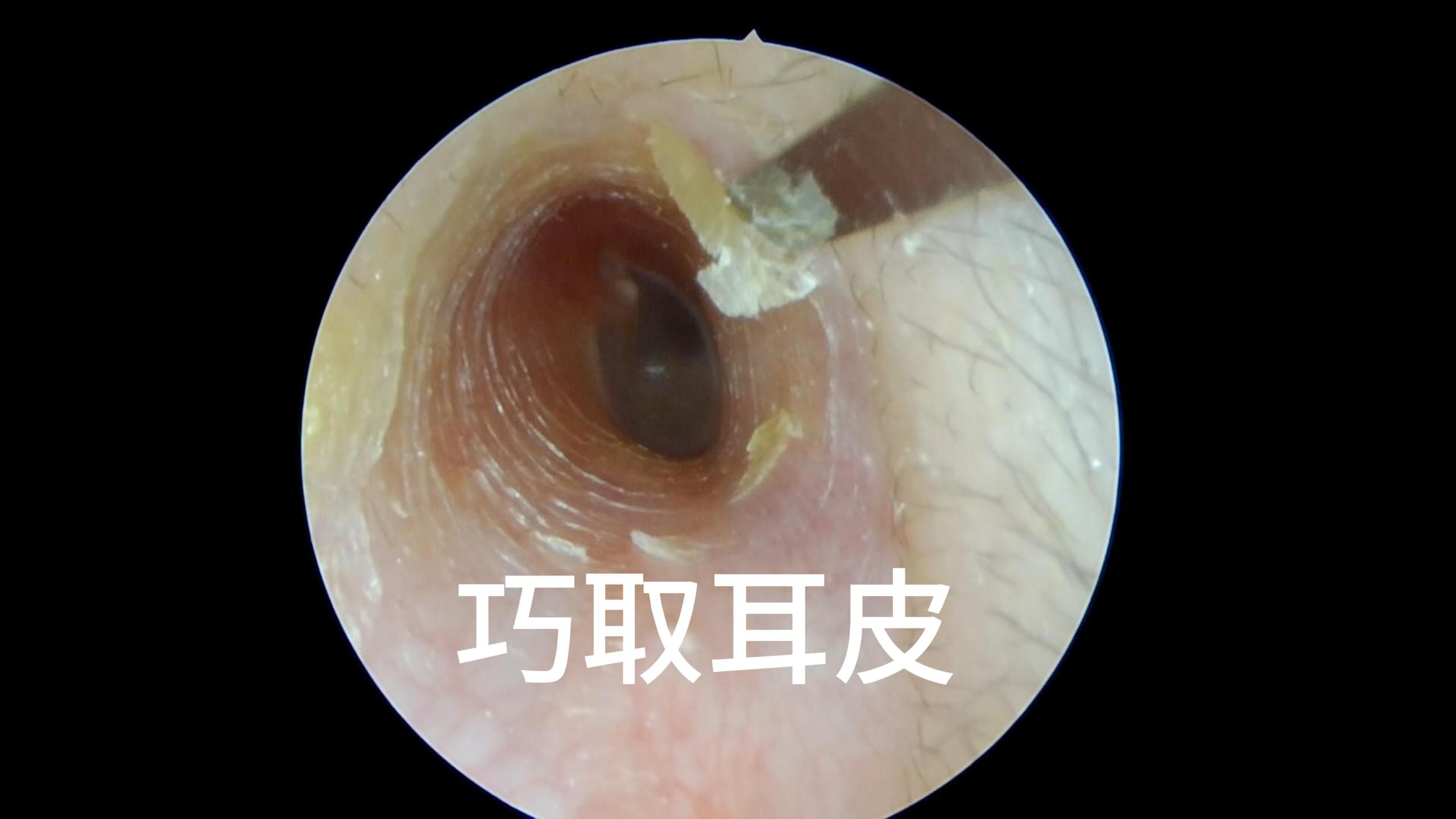 3月21日巧取耳皮