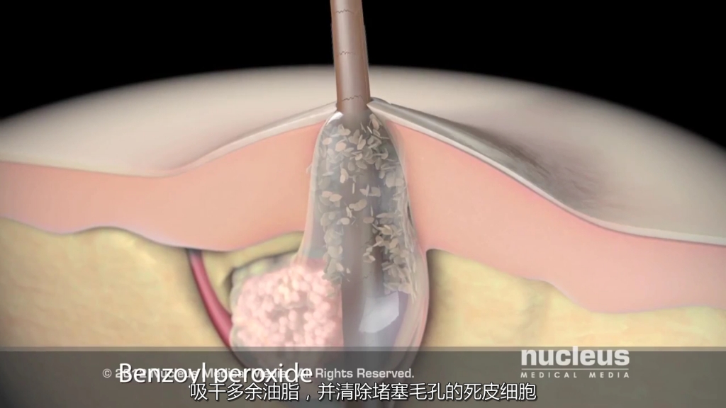 青春痘的形成原理动画演示