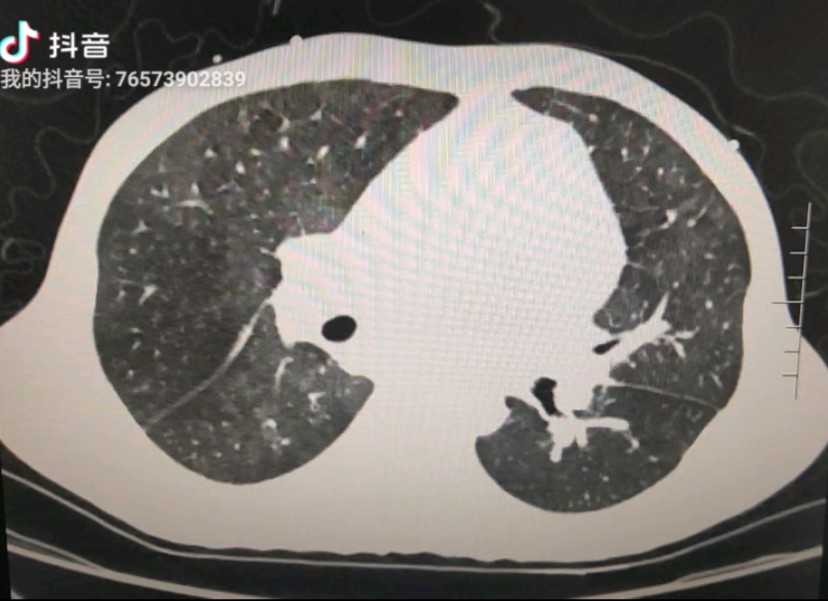 肺部CT段的分布