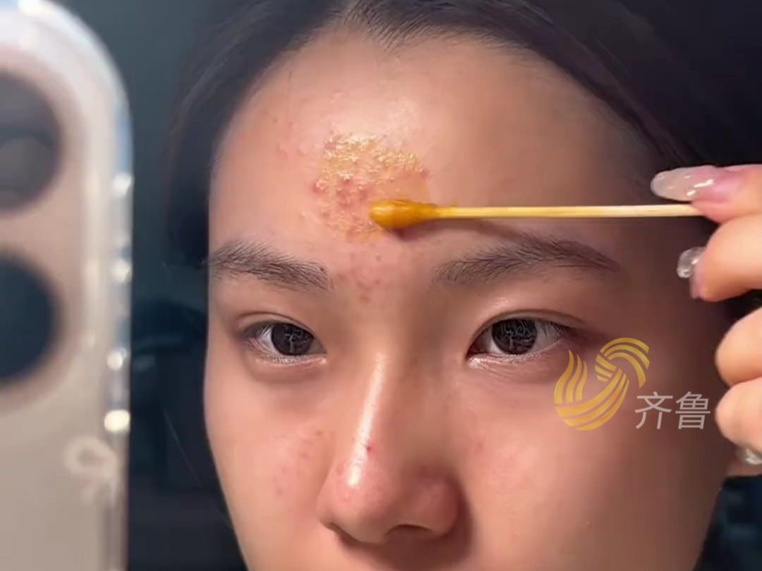 ...碘伏祛痘 两周后发现有效果,医生:去角质、消炎作用的药物有一定帮助