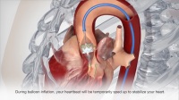 经导管主动脉瓣置换术(TAVR)——TAVR_施行